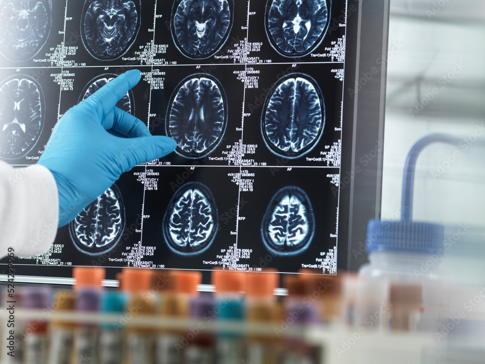 Alzheimer's and dementia research, conceptual image Stock Photo | Adobe ...