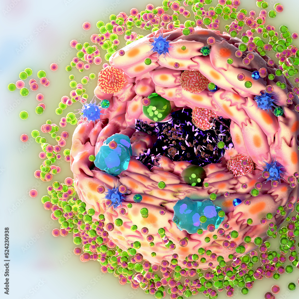 Structure of a tuberculous granuloma, illustration Stock Illustration ...