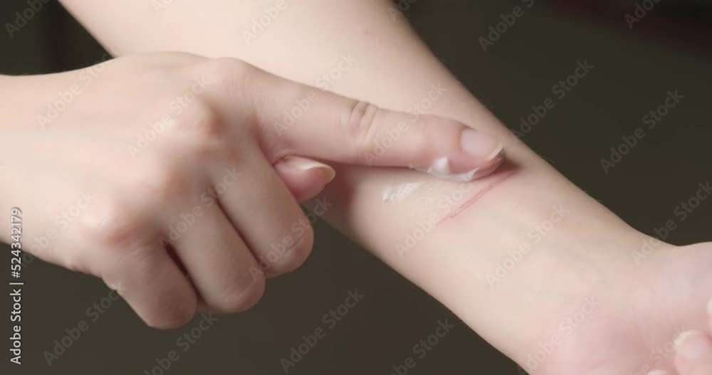 Closeup blisters, a woman applying scars removal cream to heal the ...