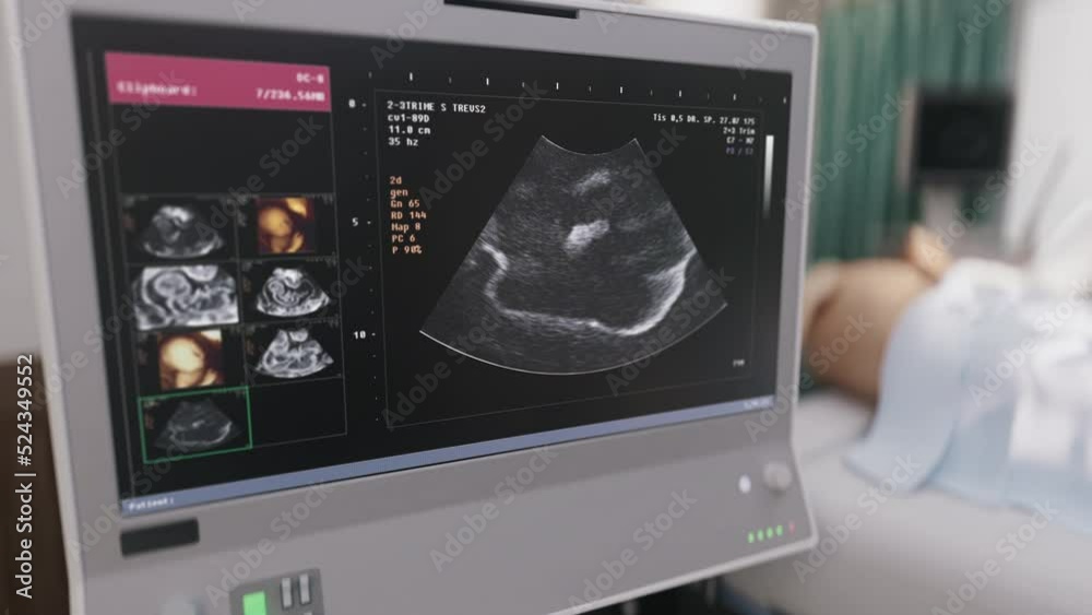 Prenatal examination computer scanning the belly of a pregnant woman ...