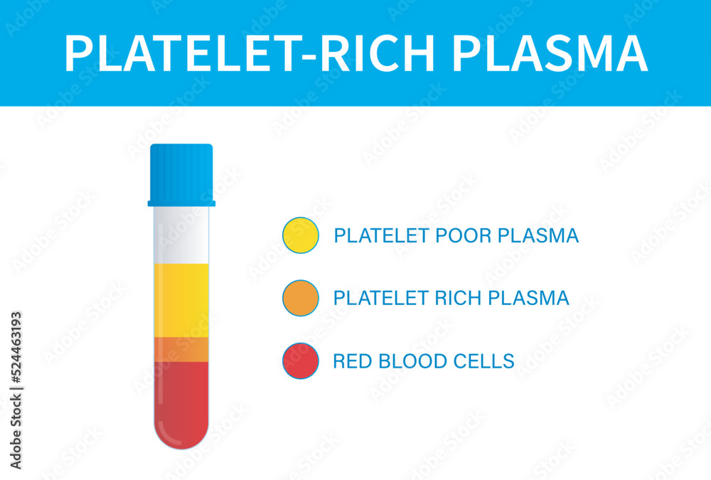 Test tube filled with blood after centrifugation of whole blood for PRP ...