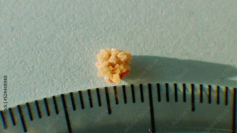 Macro shooting An oxalate stone from a human kidney close-up, measuring ...