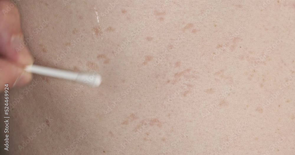 Man's hand smears areas of skin infected with pityriasis versicolor ...