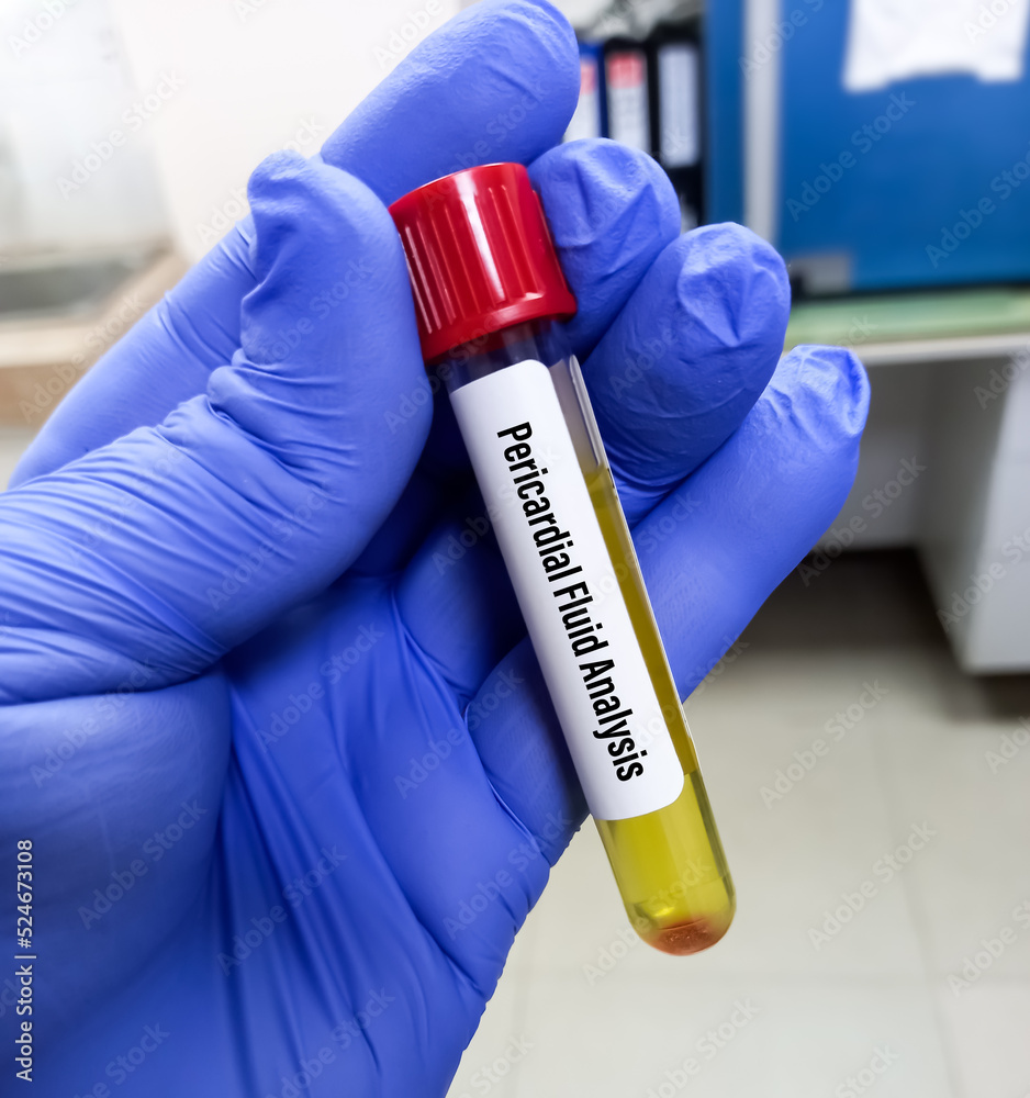 Lab technician hold Pericardial fluids for analysis. Pericardial ...