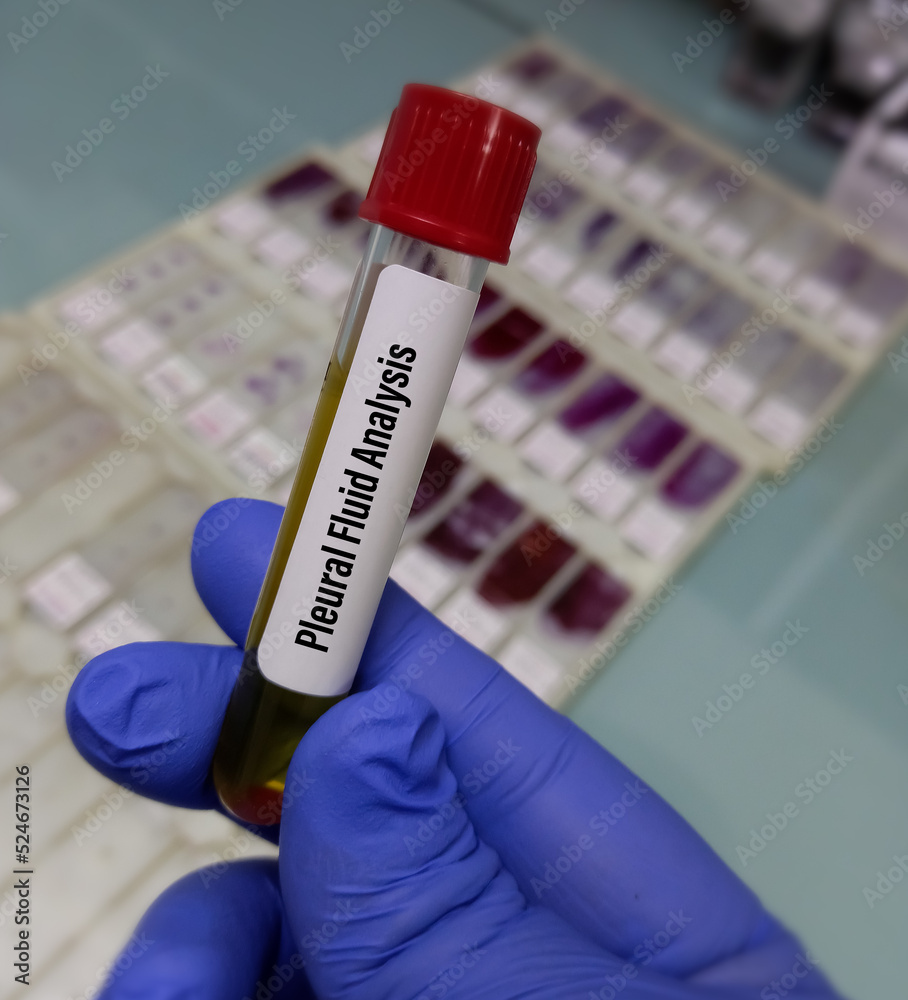 Biochemist or medical technologist hold Pleural fluid analysis sample ...