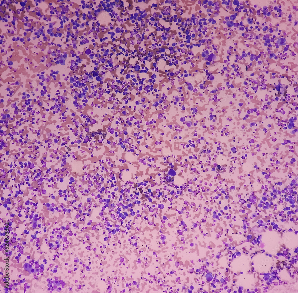 Microscopic image of bone marrow. Plasma cell dyscrasia or Multiple ...