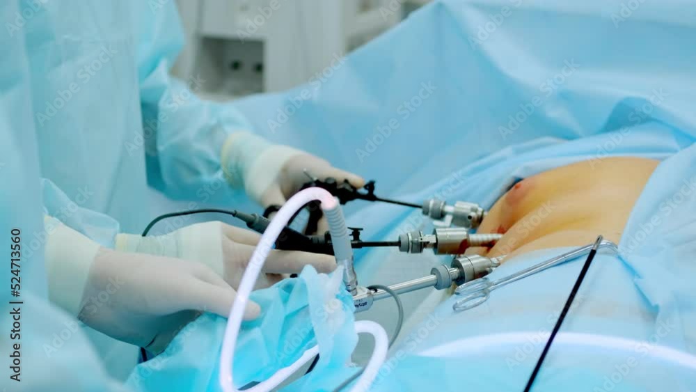 Vídeo do Stock: Hands of surgeons with the help of endoscopic equipment ...