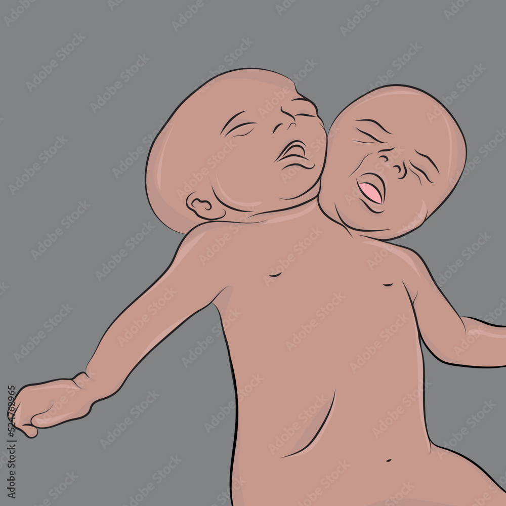 Policefalia is the condition of having more than one head. Siamese ...