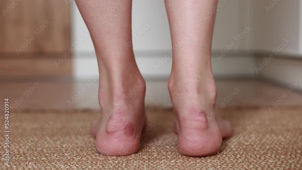 woman scratches her foot with calluses blisters. Painful wounds ...