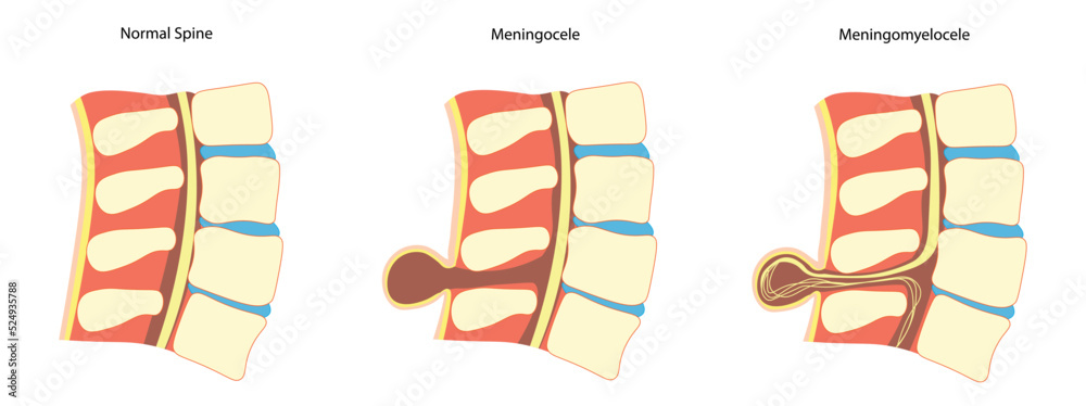 Póster Types of Spina bifida illutration – Cuadro para Pared | Posters.es