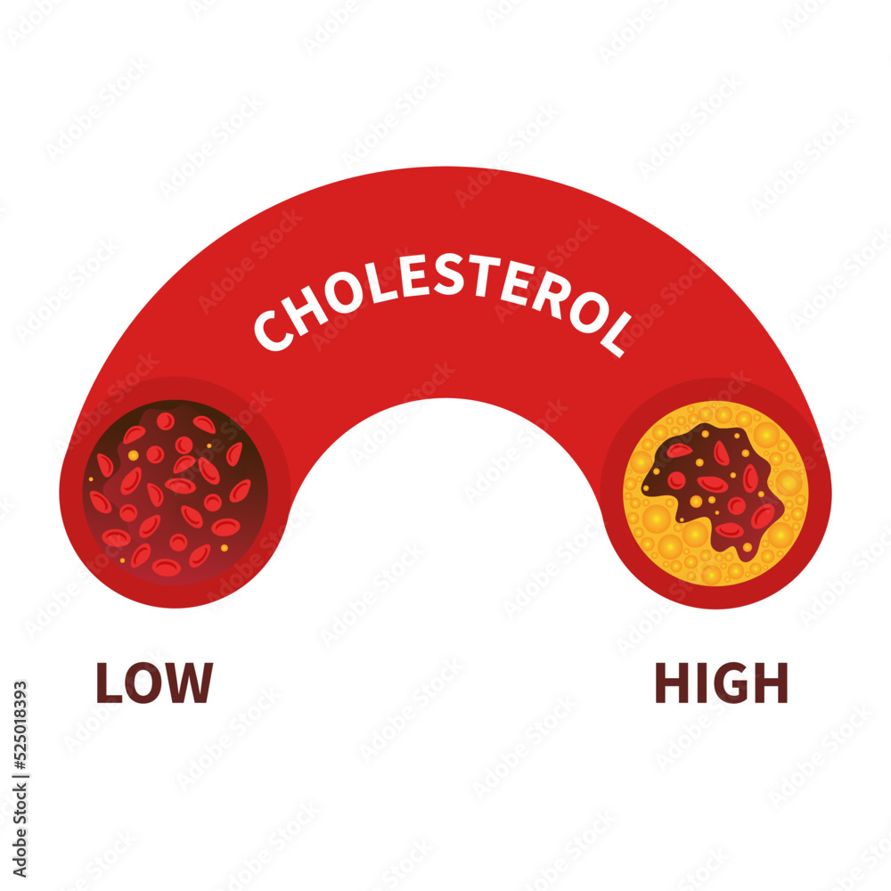 Cholesterol level on blood vessel medical diagram. Meter gauge of ldl ...