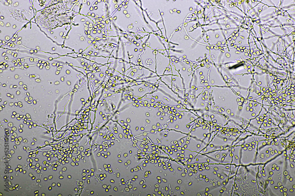 Picture of fungus and red blood cells in hemoculture tube, analyze by ...