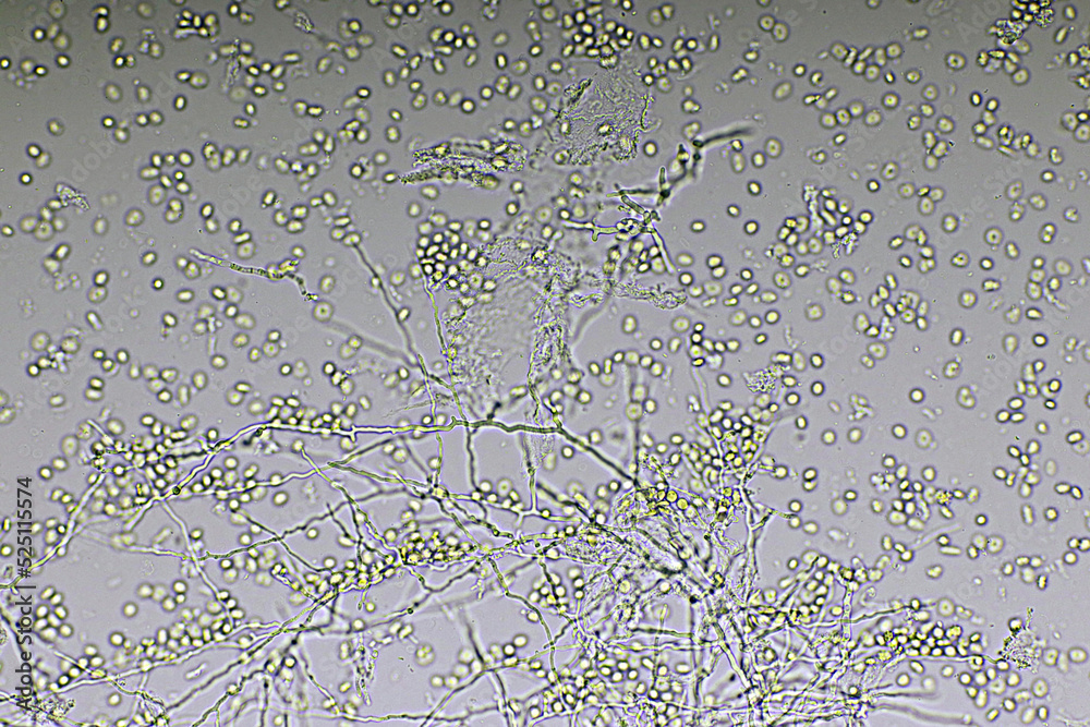 Picture of fungus and red blood cells in hemoculture tube, analyze by ...