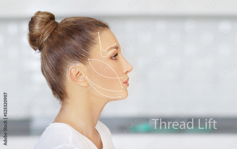 Thread Lift ,markup,technique for performing nonsurgical lifting ...