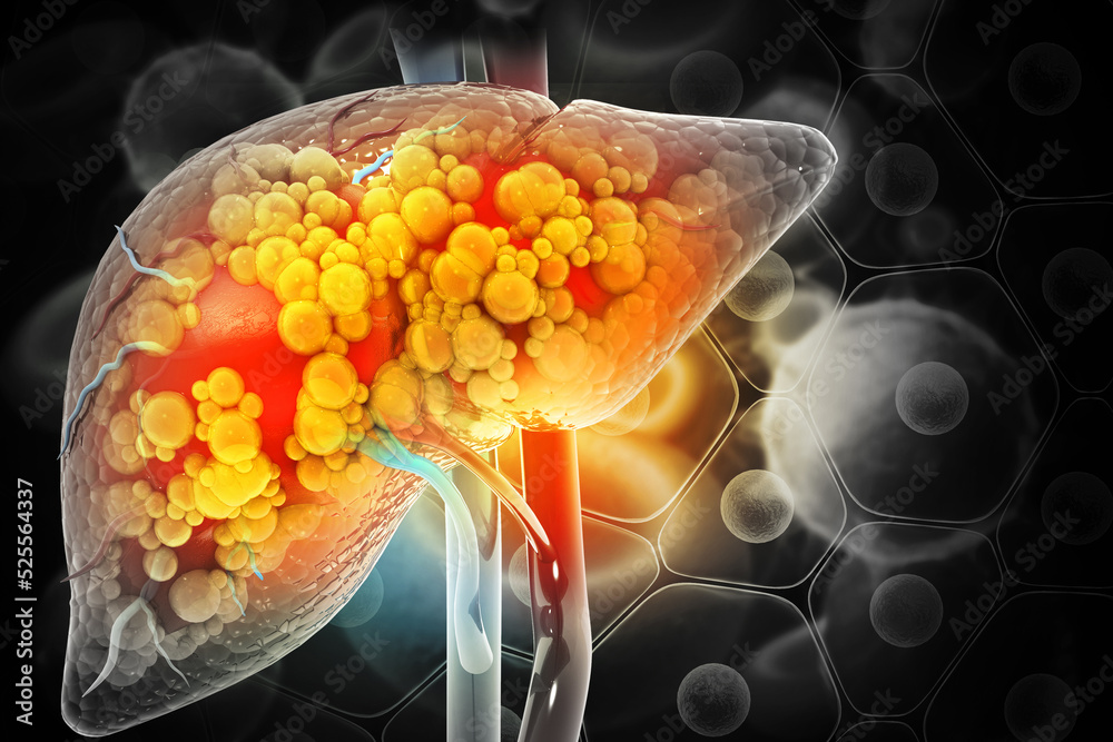 Liver damage such as Fatty liver, Fibrosis, Cirrhosis, and Liver cancer ...