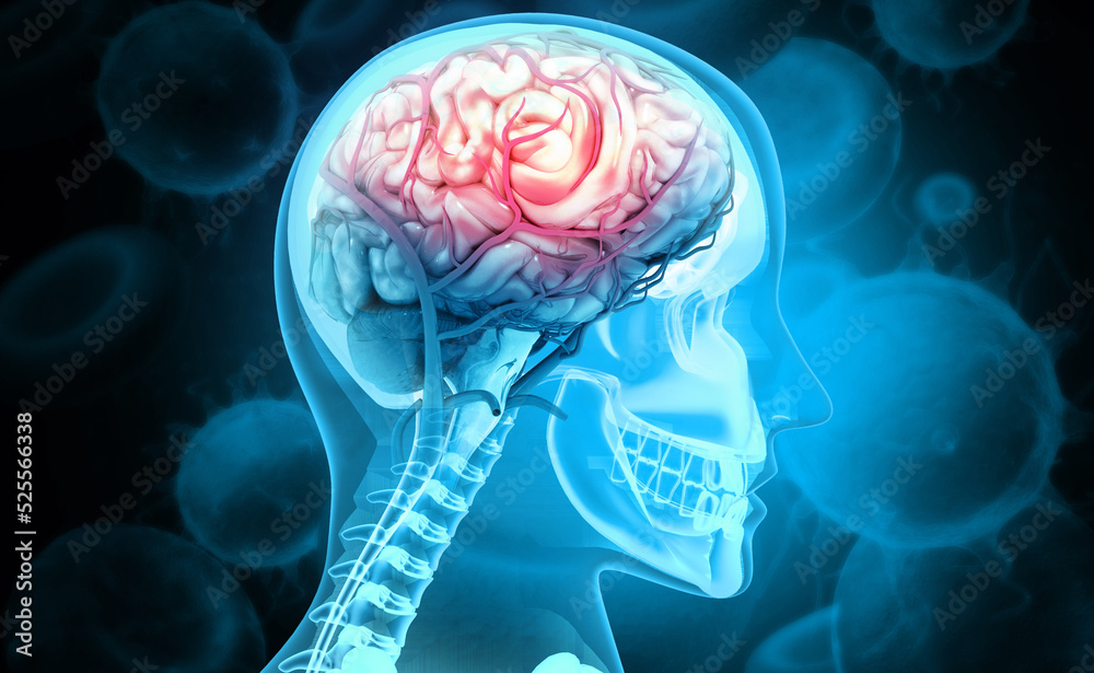 Human brain injury,damage,hemorrhage. 3d illustration Stock ...