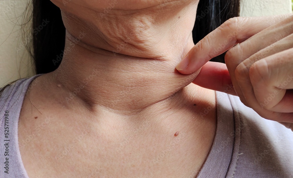 Portrait the flabbiness adipose hanging skin under the neck, wrinkles ...