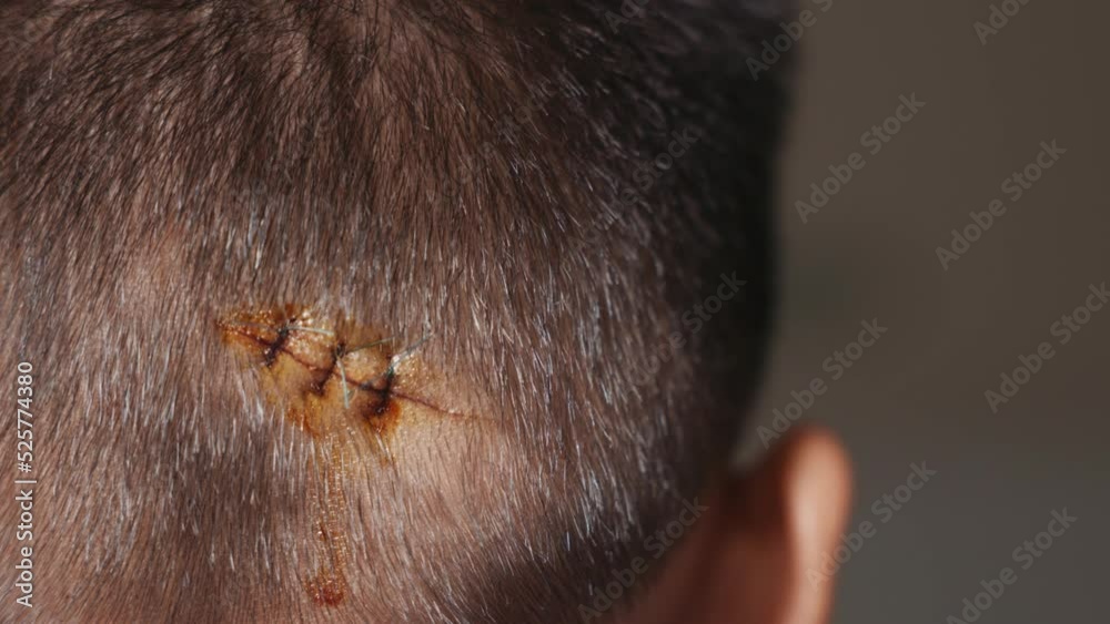 The lacerated sutured wound of kid back head which suture by nylon ...