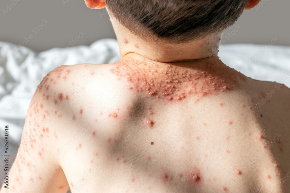 little baby boy with severe form of varicella,chickenpox virus.back ...