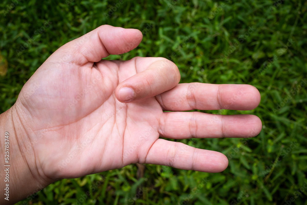 Trigger Finger lock on index finger of woman's front left hand ...