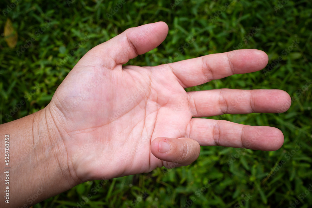 Trigger Finger lock on little finger of woman's front left hand ...