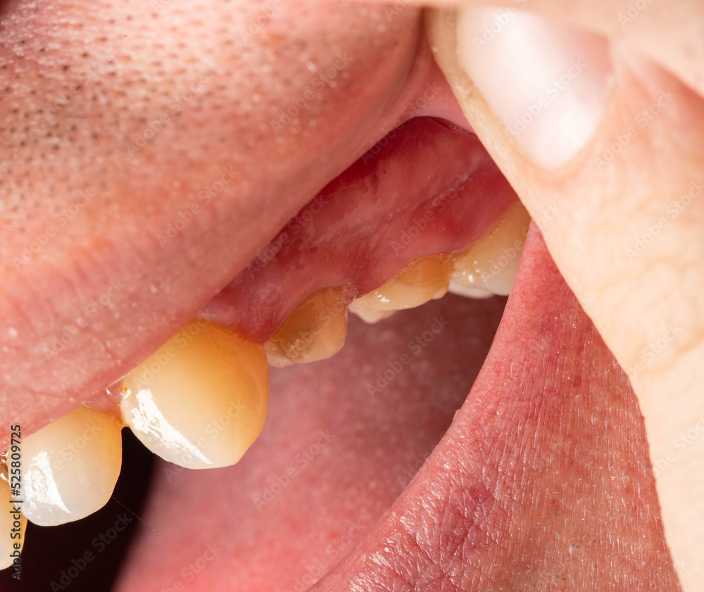 Grind teeth under a metal-ceramic crown in a man's mouth. Dental ...