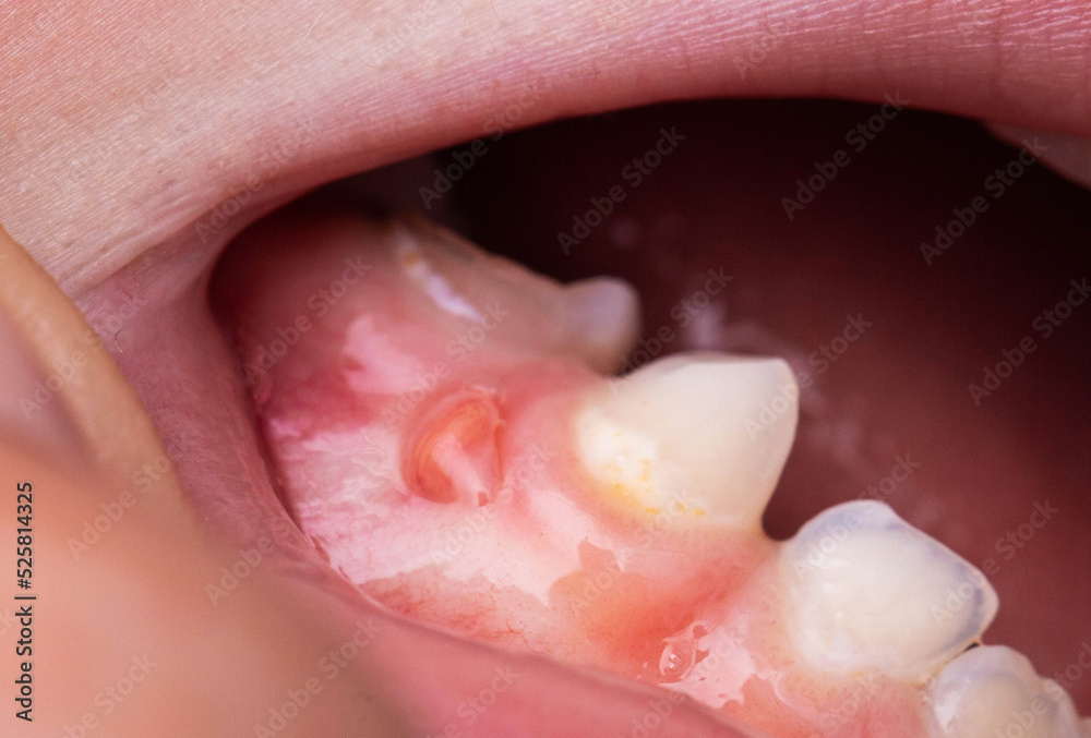 A bump is a tumor on the tooth gum in a child. Periodontitis in ...
