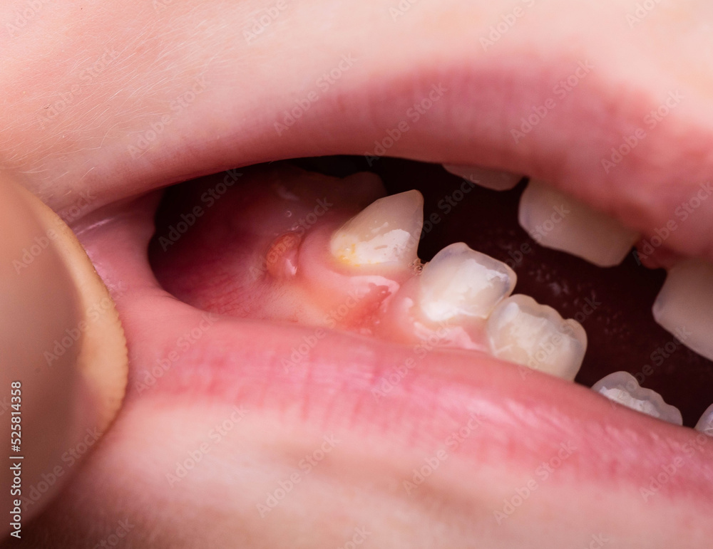 A bump is a tumor on the tooth gum in a child. Periodontitis in ...