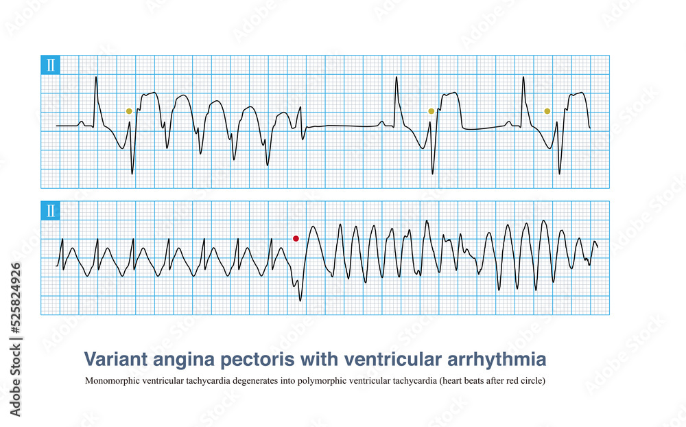 A 62 year old male presented with variant angina pectoris and syncope ...