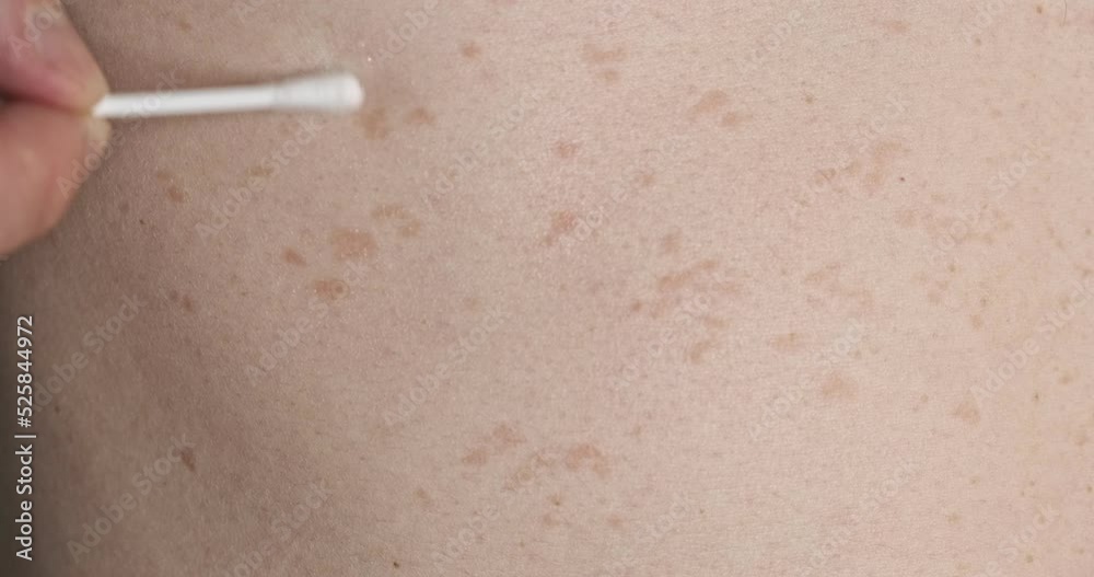 Caucasian man smears red spots on his skin with a cotton swab ...