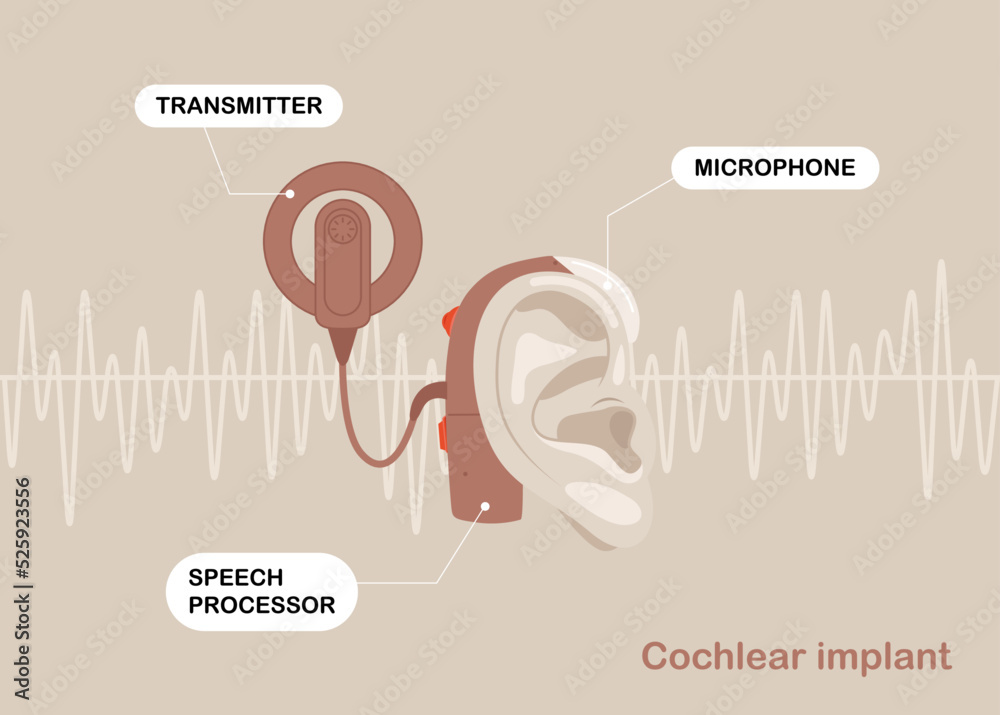 Treatment and prosthetics of hearing loss in otolaryngology. Cochlear ...