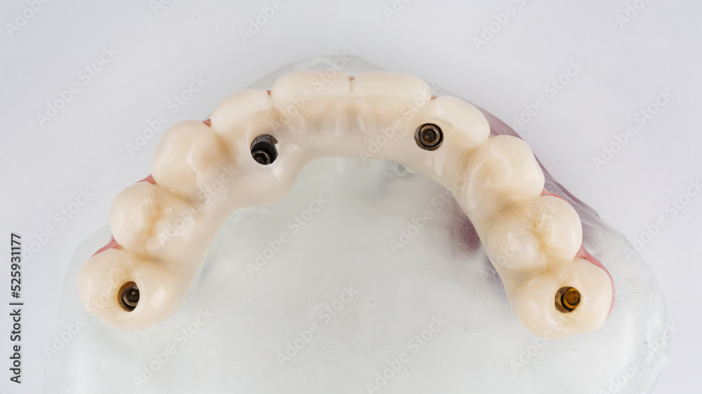 morphology of a temporary dental prosthesis on a top view model on a ...