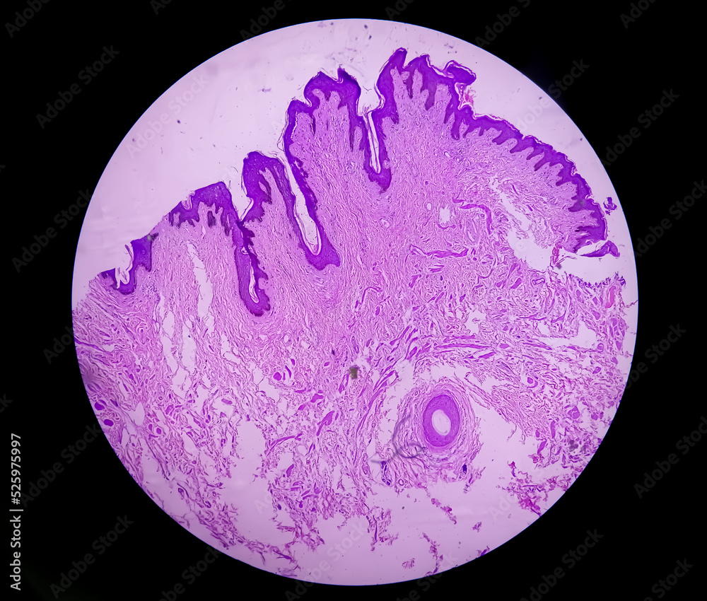 Histological biopsy of Scrotal wall under microscopy showing Calcinosis ...