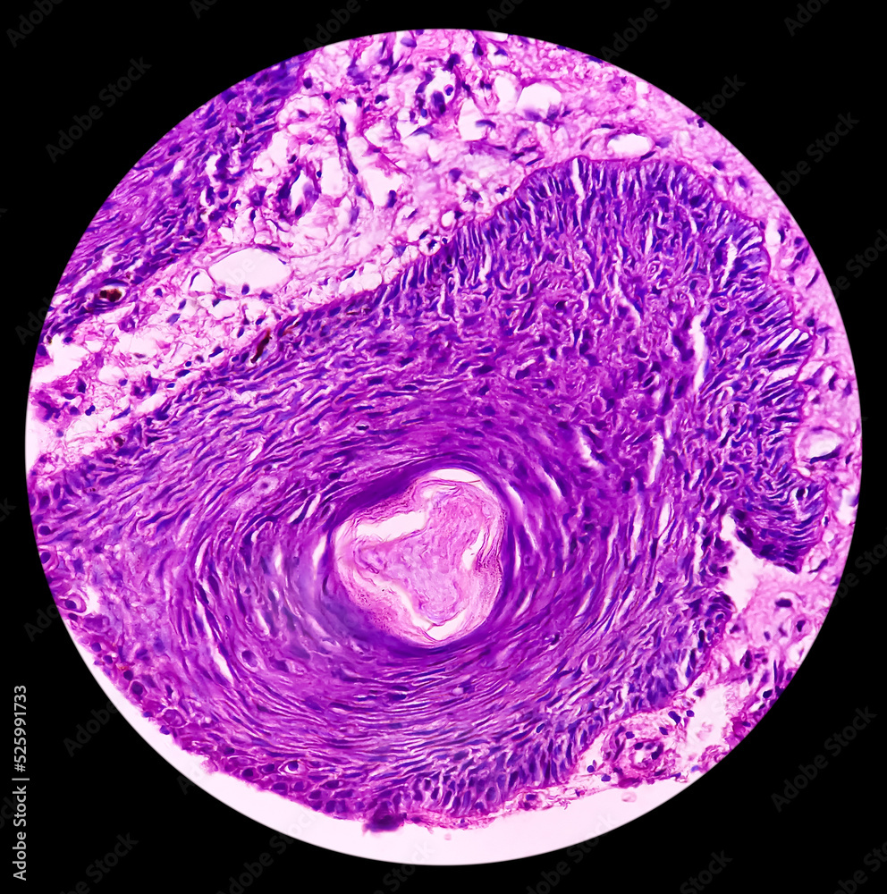 Non healing ulcer on scalp, microscopic image show skin, features of ...