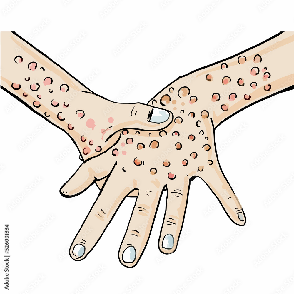 cartoon unclean hands infected with disease Stock Illustration | Adobe ...