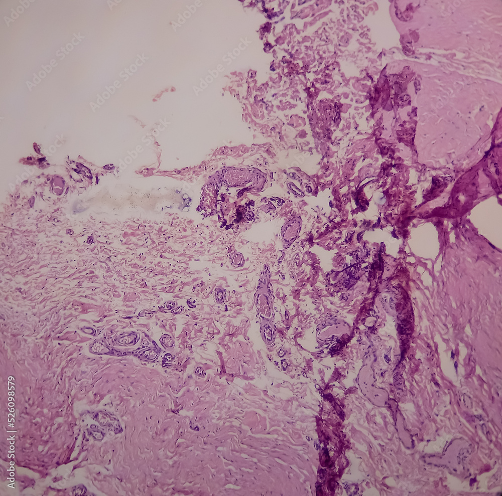 Knee joint(biopsy): Ganglion cells, show microscopic view cyst wall ...