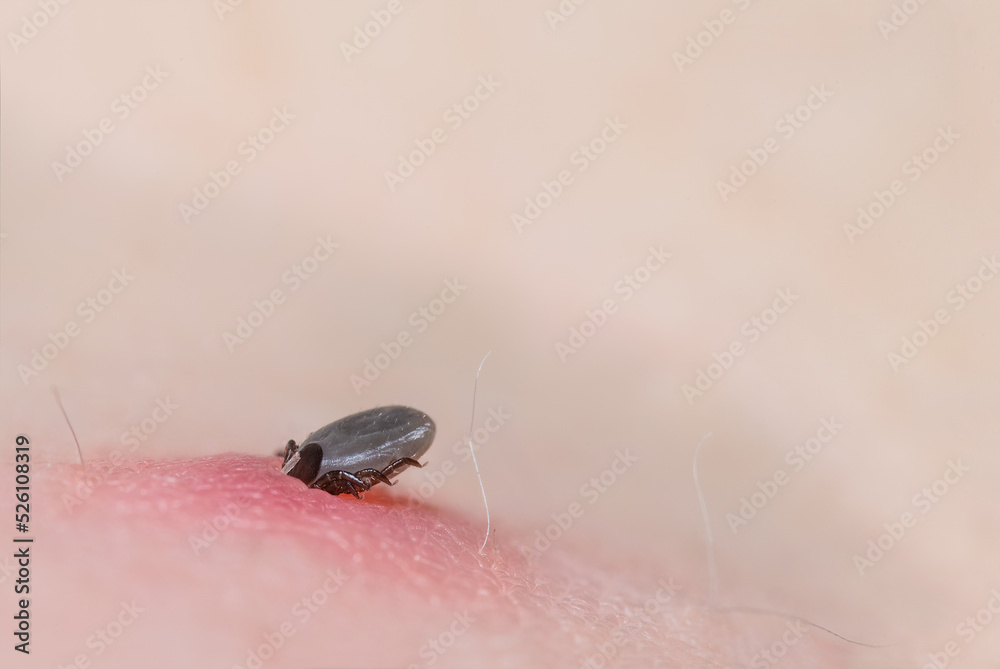 Female deer tick nymph bitten in pink irritated skin. Ixodes ricinus ...