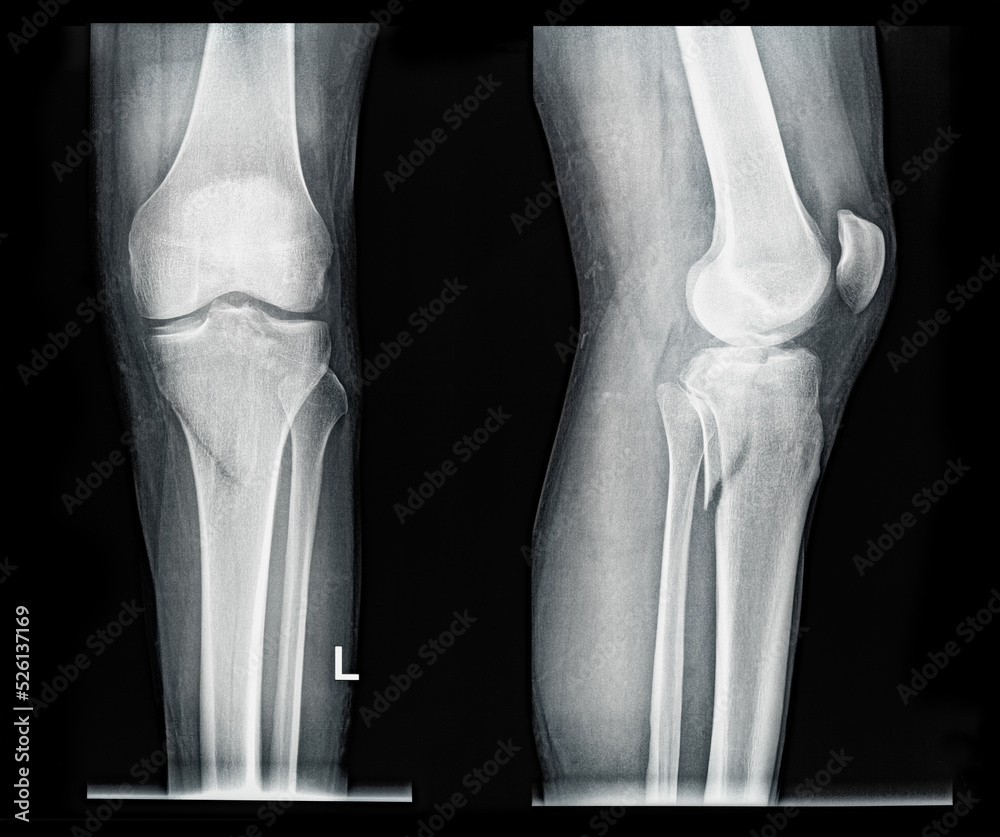 Xray MRI images showing real fracture of leg bone under the knee after ...