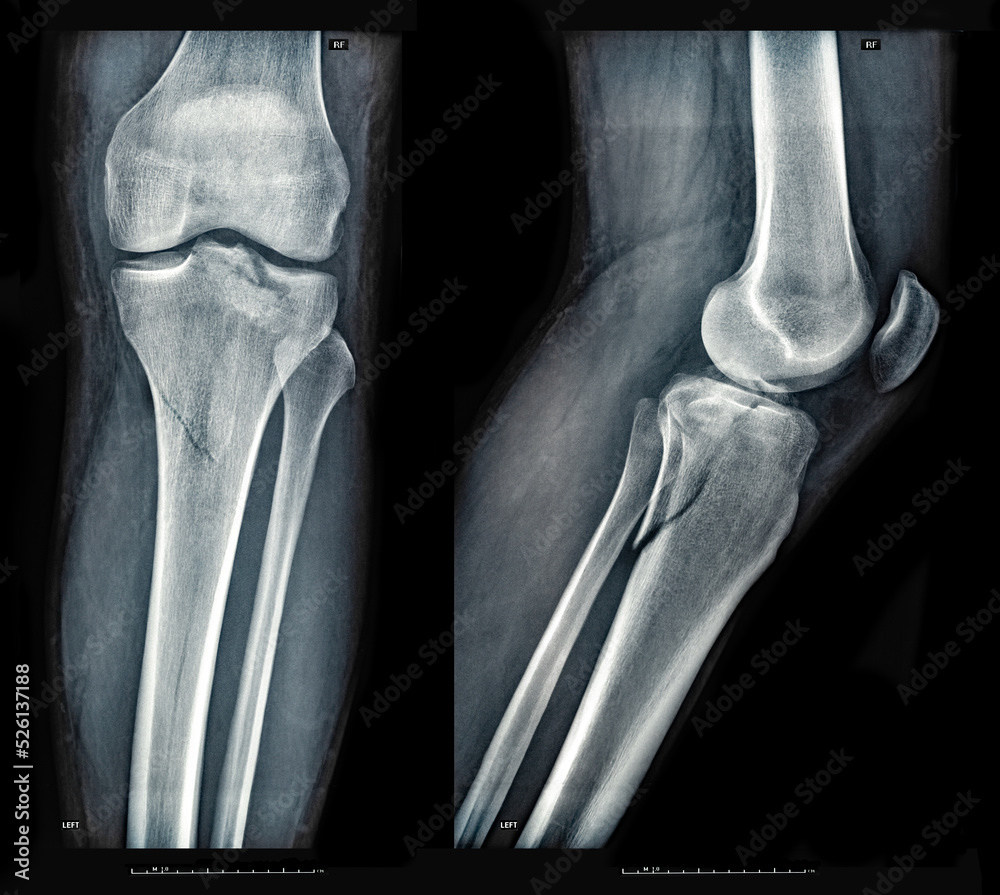 Xray images showing real fracture of leg bone under the knee after injury foto de Stock | Adobe ...