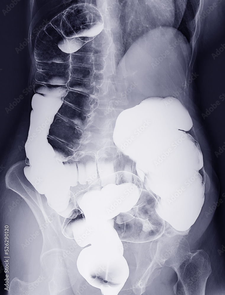 Barium enema or BE is image of large bowel after injection of barium ...