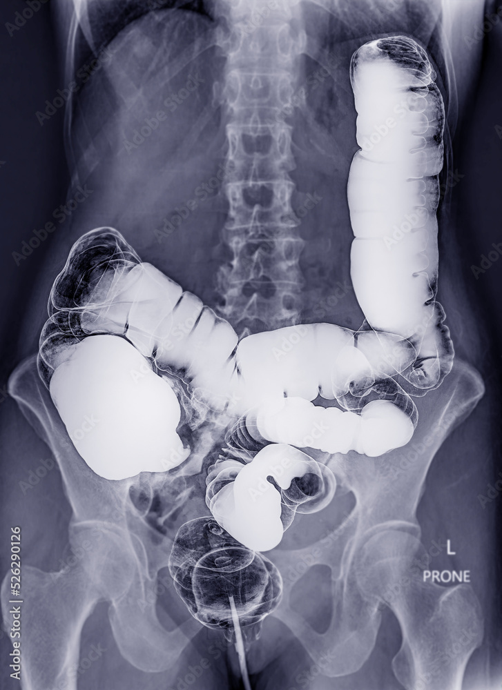 Barium enema or BE is image of large bowel after injection of barium ...