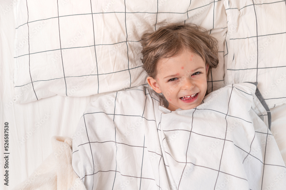 Toddler Child lying in bed with red spots on skin typical of chicken ...