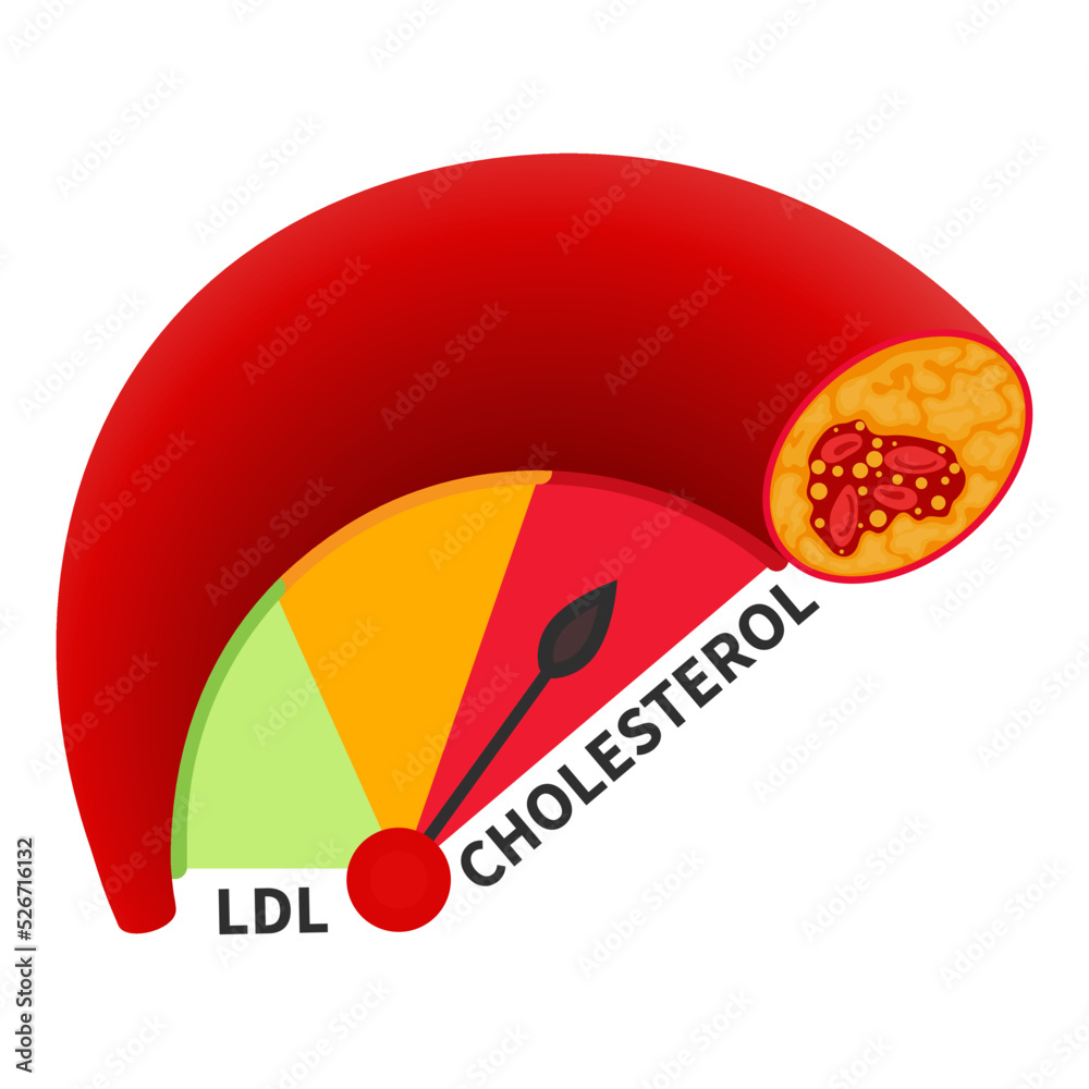 LDL cholesterol level on blocked blood vessel medical diagram. Meter ...