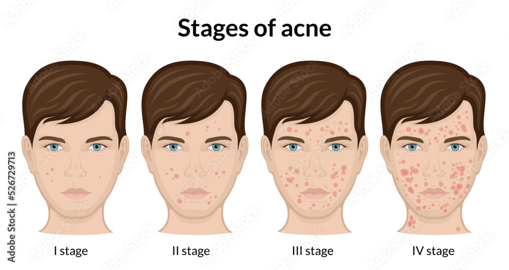 Four stages of acne on the face of a young man Stock Vector | Adobe Stock