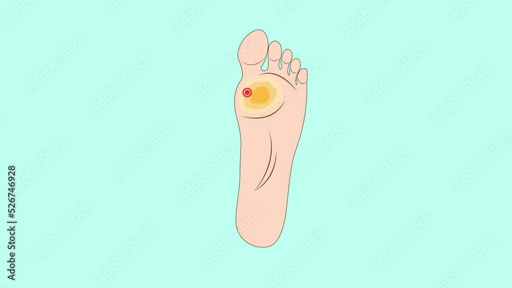 Treatment of diabetic foot ulcer. Old woman feet damage. Blood glucose ...