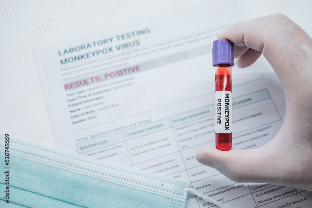 Hand holding blood collection tubes and data sheet on monkeypox test ...