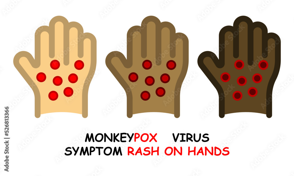 set of three monkeypox symptoms icons. flat icon with outline icon ...