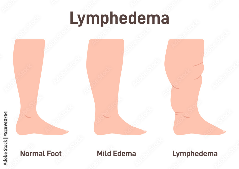 Lymphedema stages. Lymphatic system dysfunction disease. Swollen legs ... Lymphedema stages. Lymphatic system dysfunction disease. Swollen legs ...