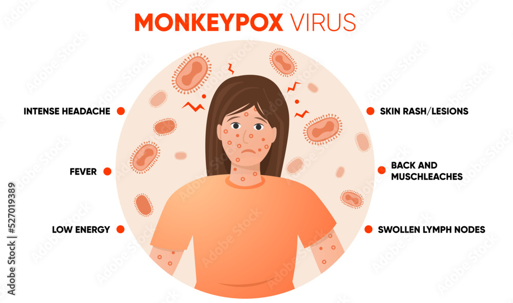 Monkeypox virus symptoms simple infographic. Poster for social media ...