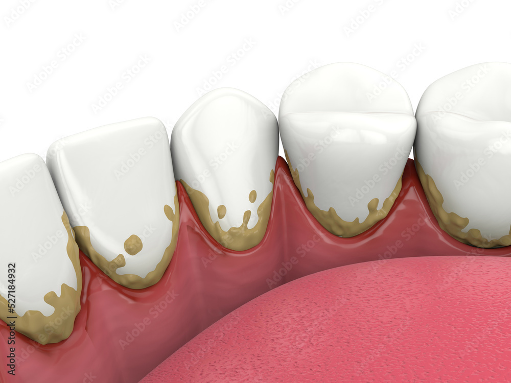 3d render of lower jaw with calculus buildup on teeth line and making ...